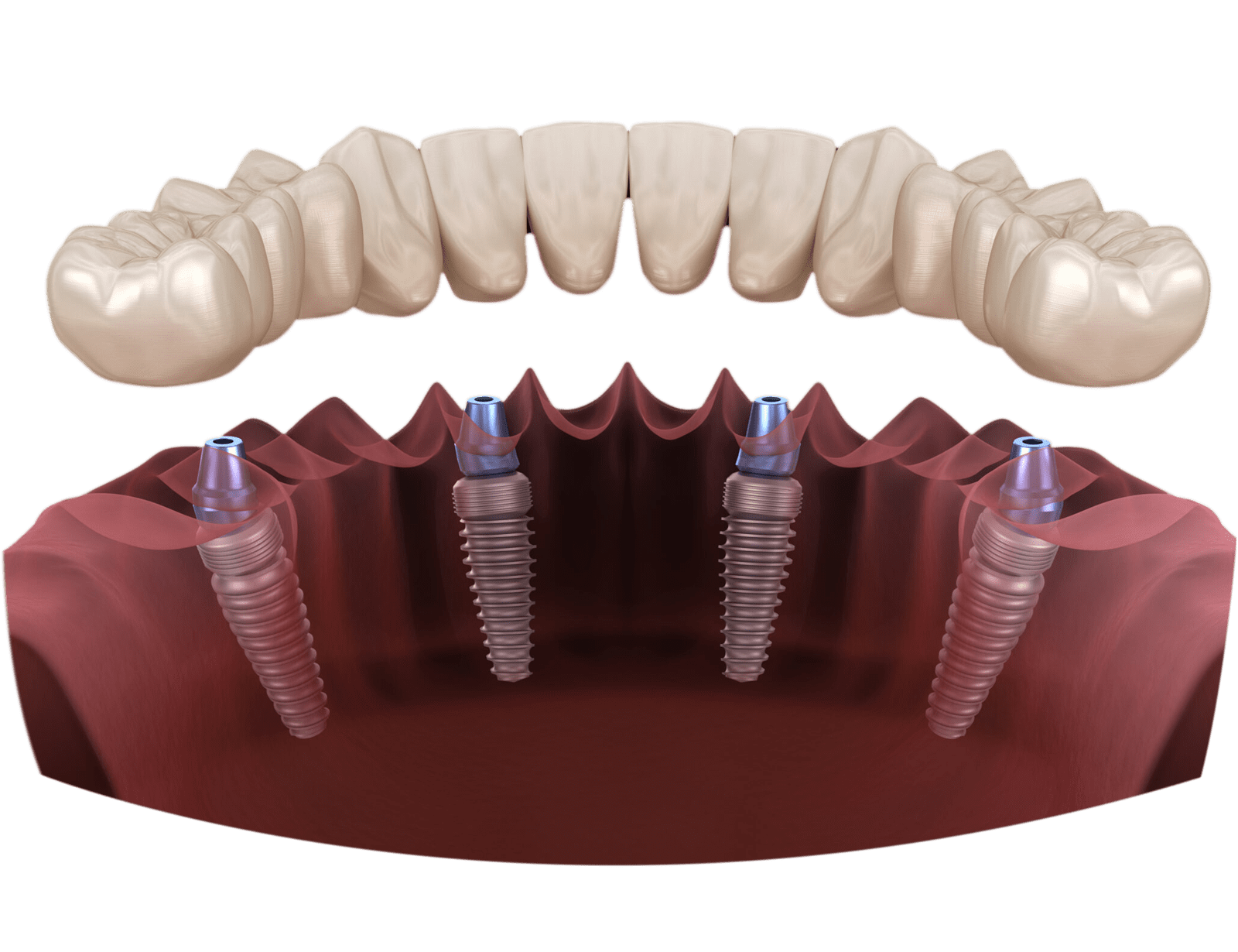 All on 4 / All on 6 – Dentetik | Dental Clinic in Istanbul / Turkey