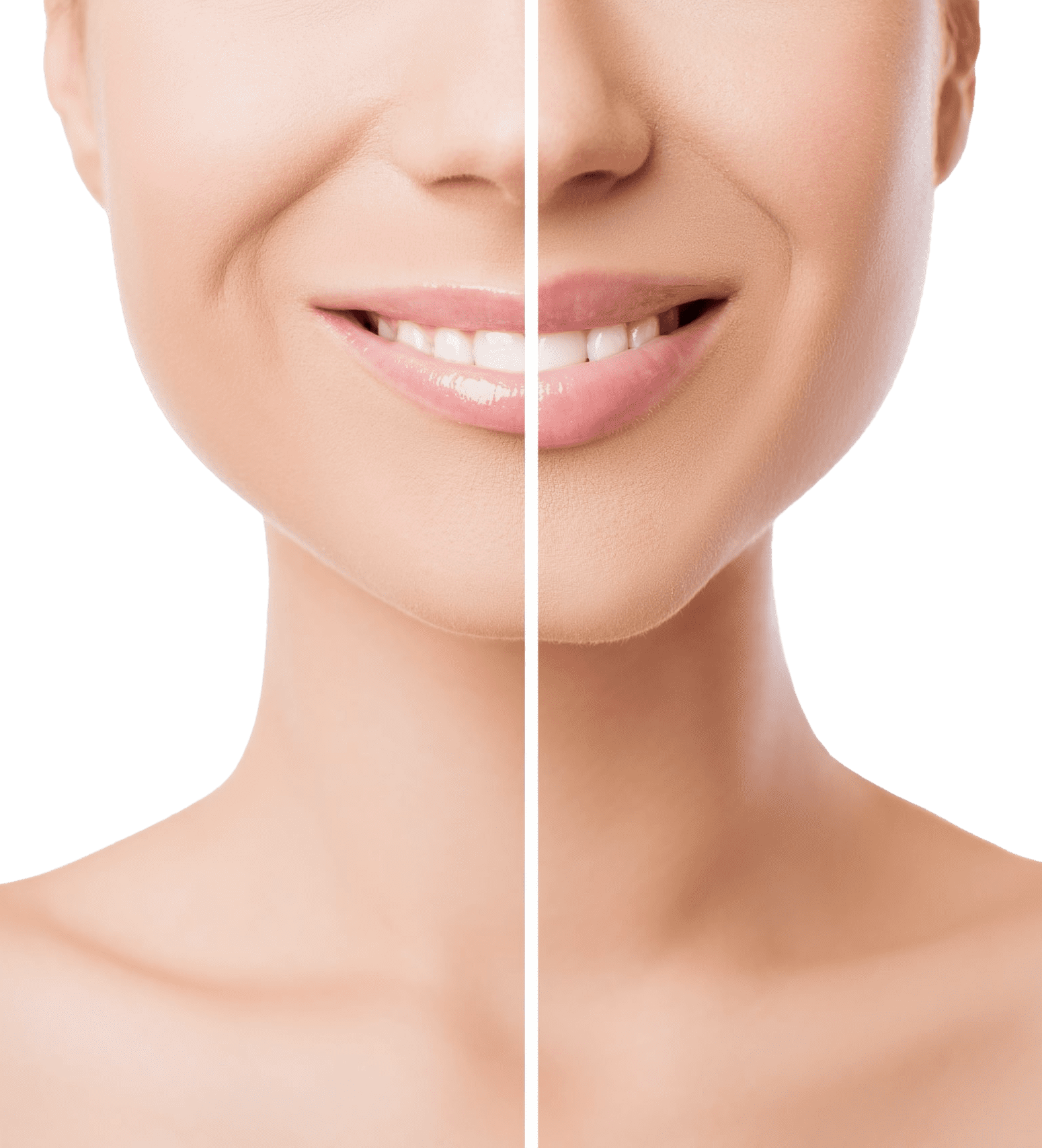 Smile Makeover – Dentetik | Dental Clinic in Istanbul / Turkey