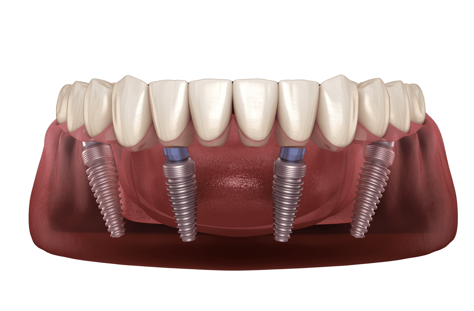 Fast&Fixed (All On Four) | Dentetik Ağız ve Diş Sağlığı Polikliniği
