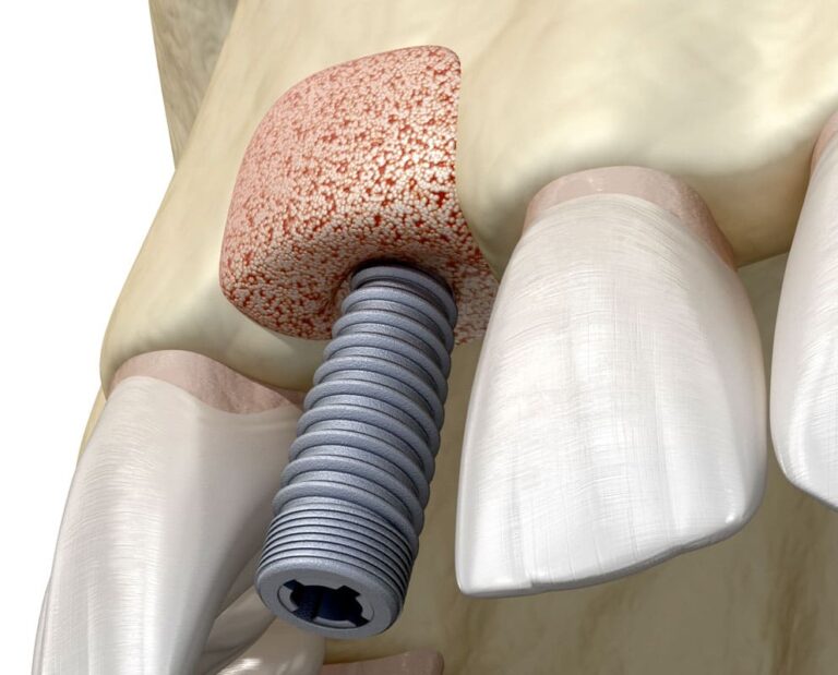 Greft Uygulaması | Dentetik Ağız ve Diş Sağlığı Polikliniği