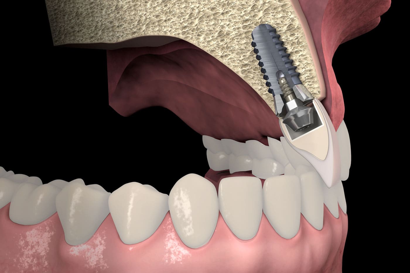 Greft Uygulaması | Dentetik Ağız ve Diş Sağlığı Polikliniği