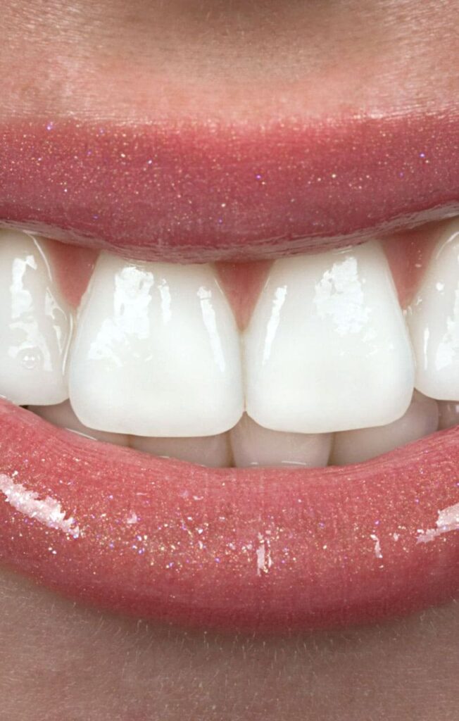 Kompozit Laminalar | Dentetik Ağız ve Diş Sağlığı Polikliniği