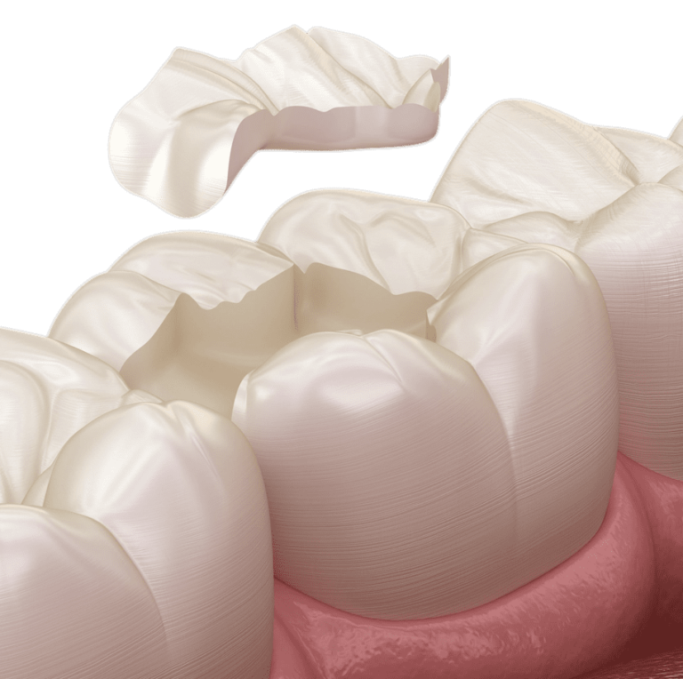Porselen Inlay & Onlay | Dentetik Ağız ve Diş Sağlığı Polikliniği